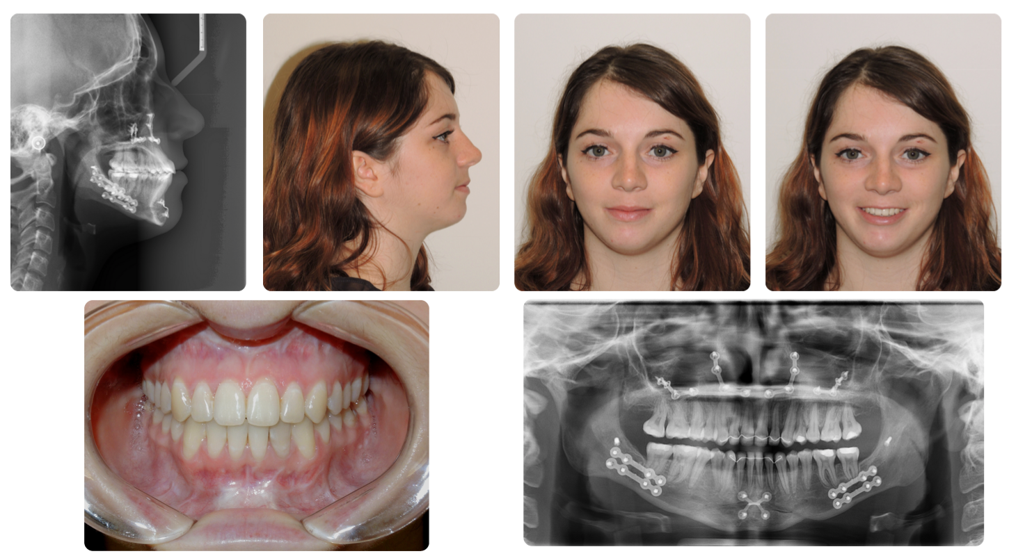Overbite Surgery Procedure